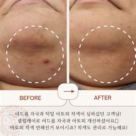 프리미엄 에스테틱 미더베스트 마곡점 모든 착색 고민은 Methebestmagok