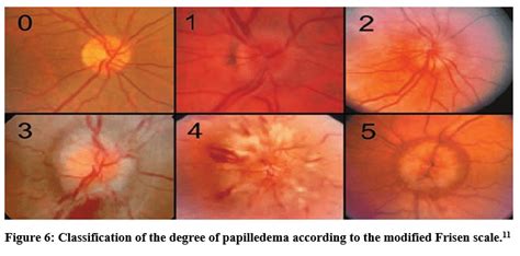 Unilateral Papilledema As A Rare Manifestation Of Cerebral Neurotoxoplasmosis In HIV Patient