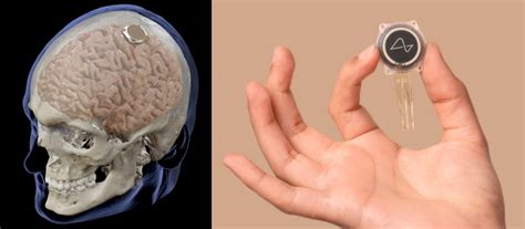 Neuralink公布腦部晶片人體試驗成果，讓四肢癱瘓的受試者可以透過思考控制電腦 Ithome