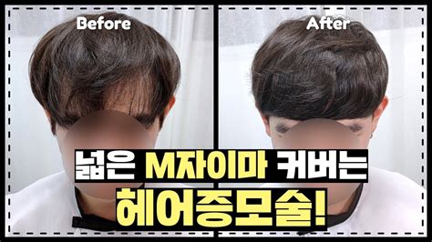M자탈모 엠자탈모 헤어증모술은 마법과 같아요 1시간만에 이런일이 Youtube