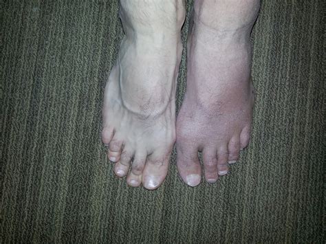Glass Half Full Recovering From A Jones Fracture