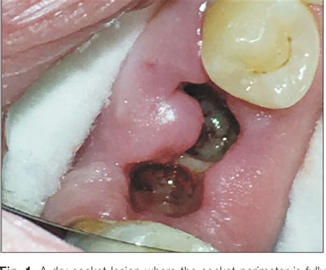 Figure From Dry Socket Etiology Diagnosis And Clinical Treatment Techniques Semantic Scholar