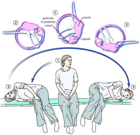 Epley Manoeuvre Diagram Epley Maneuver Vertigo Bppv Rosh Man