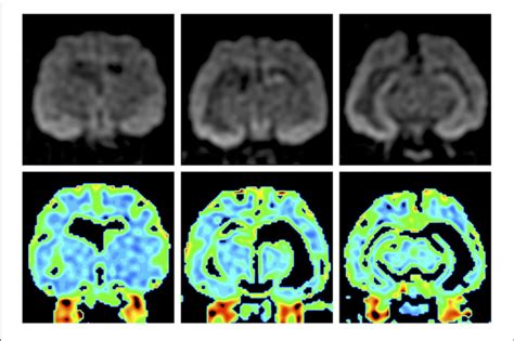 Preoperative Isotropic Diffusion Weighted Imaging Upper Row And