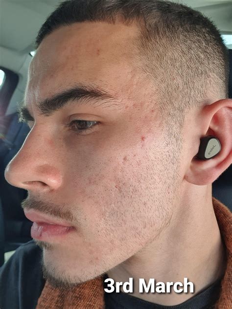 7 Week Progress On Minox Dermarolling 1x Per Week 15mm For Past 2