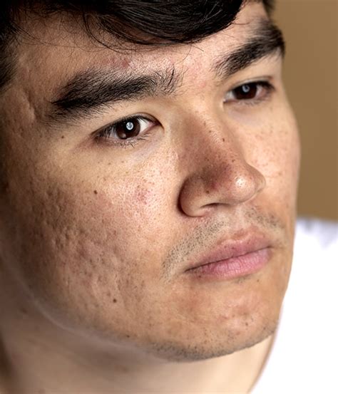 7 Best Treatments For Atrophic Acne Scars Shinesheets