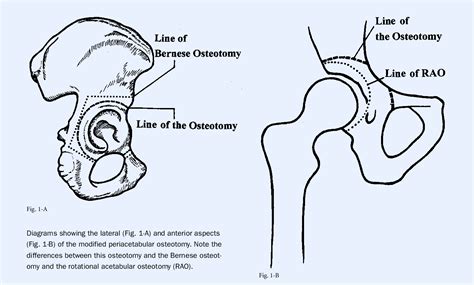 Figure 1 From A Modified Periacetabular Osteotomy With Use Of The