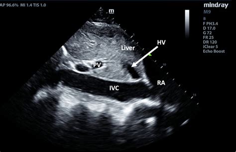 Cardiac Views Toronto Internal Medicine Pocus