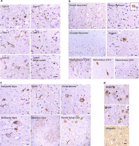 Histopathologic Characteristics Of Ftld Tdp Type E A Representative