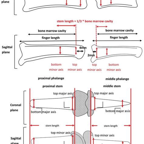 Pip Joint Implant Design Concept Medullary Canal Estimation And Stem