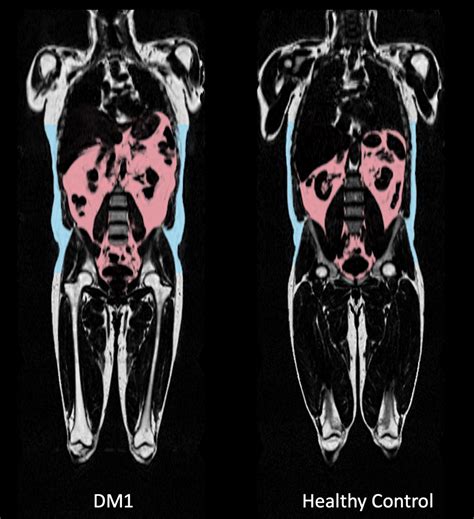 Energy Expenditure Body Composition And Skeletal Muscle Oxidative