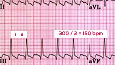 Heart Rate Calculation ECG Interpretation Quick Review