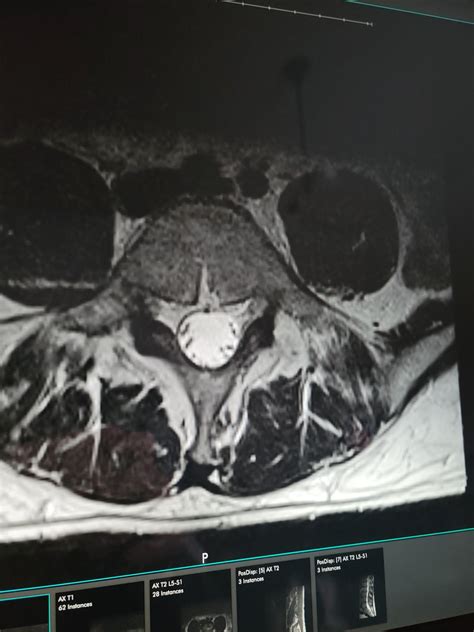 Left Psoas Trying To Run Away 😂 Rradiology