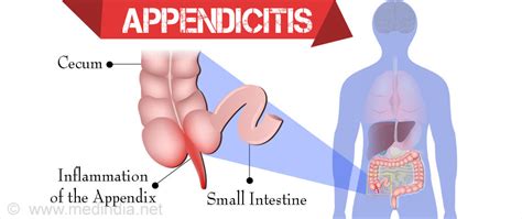 Appendectomy Surgery Surgery Center Houston Tx Appendectomy