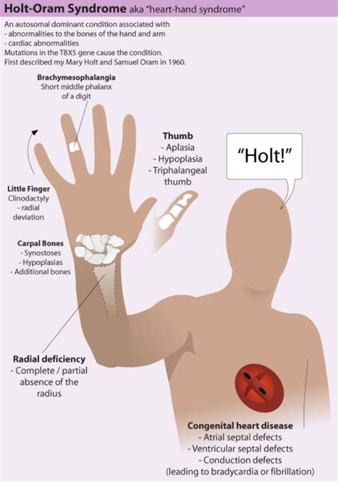 Holt Oram Syndrome Effect On Population