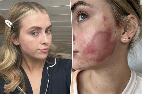 Woman Left With Second Degree Burns Scarring After Common Beauty