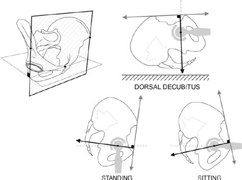 Anatomic Or Morphologic Anteversion Can Be Measured Reliably By Using