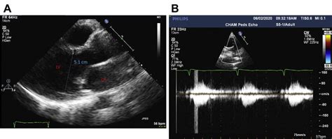 A Post Pda Closure Tte Lvedd Of 5 1 Cm B Follow Up Tte Closure Of Download Scientific