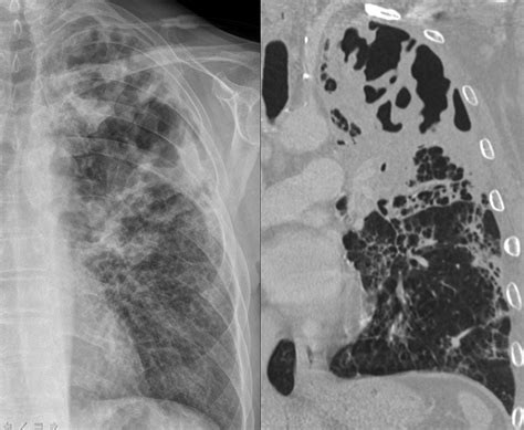 Necrotizing Pneumonia