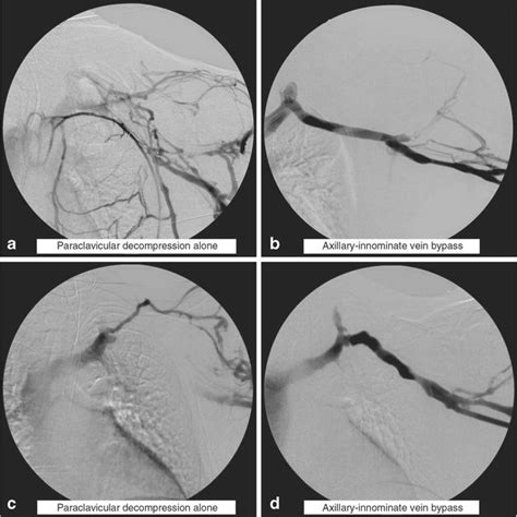 Subclavian Vein Bypass Graft Reconstruction Intraoperative Left Upper