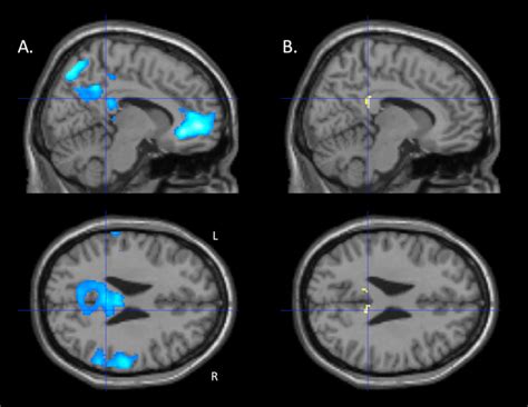 Figur 3 A Negative Bold Response In The Posterior Cingulate Cortex In Download Scientific