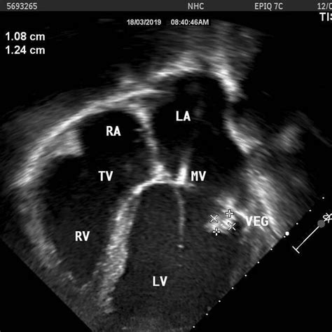 Transthoracic 2d Echocardiography At Presentation Showing Echo Dense