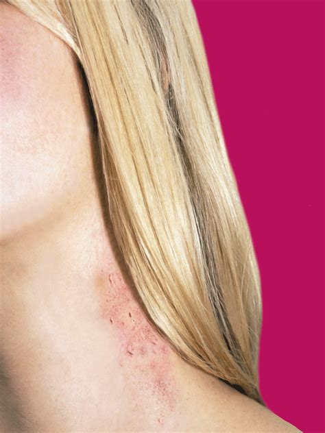 Hickey Cover Up Excuses Carrying A Fetus Diary Image Database