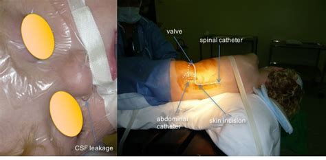 Le Drainage Lombo P Riton Al Neurochirurgie P Diatrique