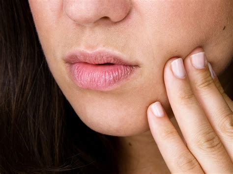 White Mouth Sores On Tongue