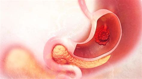 Cáncer de estómago Conoce los síntomas causas