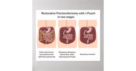 Restorative Proctocolectomy With J Pouch 2 Stages Poster Zazzle