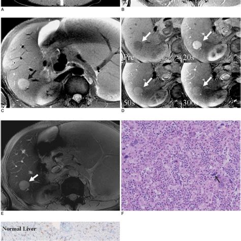 Pdf Intrahepatic Extramedullary Hematopoiesis Mimicking A Hypervascular Hepatic Neoplasm On