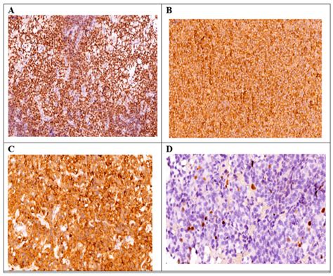 Plurihormonal Pituitary Neuroendocrine Tumors Clinical Relevance Of