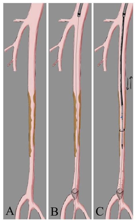 Illustration Of The Turbohawk™ Device A Multiple Preocclusive Sfa