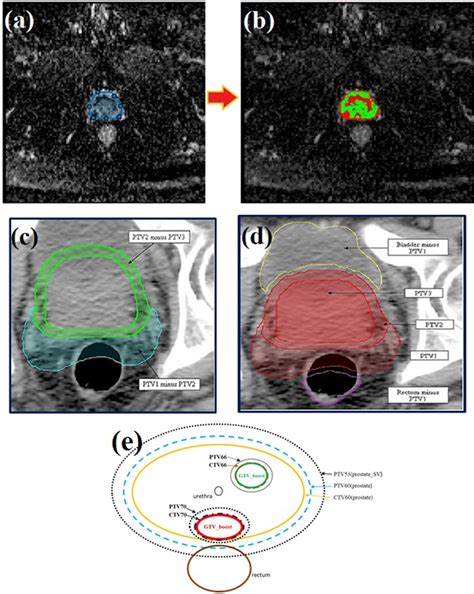 The Procedure Used To Automatically Contour The Intraprostatic Dose