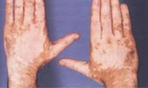 انواع سوختگی درجه یک، دو و سه