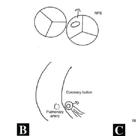 Takeuchi Procedure A Pulmonary Incision B A P Window Creation C
