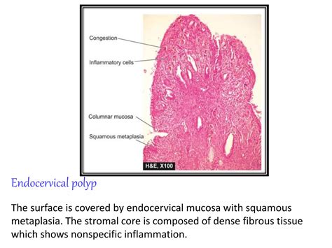 Female Genital System Cervix Lesions Pptx