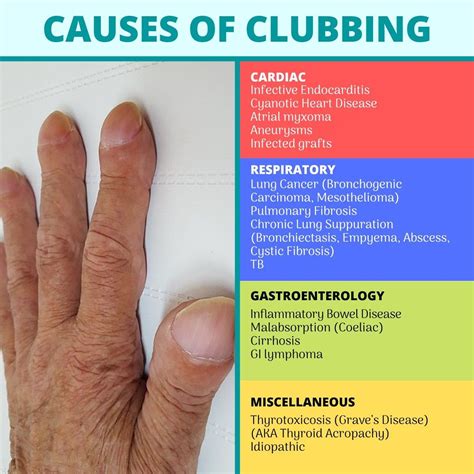 Clubbed Fingers Emphysema At Nancy Soriano Blog