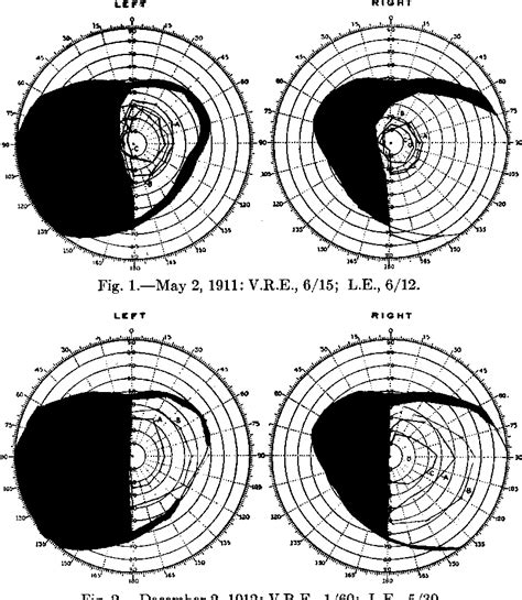 Figure From Visual Field Findings In A Case Of Brain Tumor Semantic Scholar