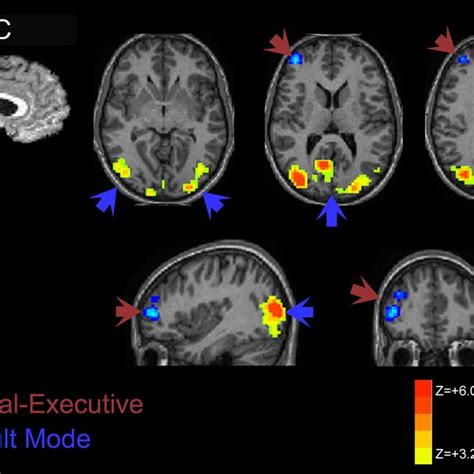 Posteromedial Cortex Connectivity Comparison Of Late Preterms Versus