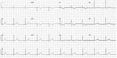 Ecg Case 299 Manual Of Medicine