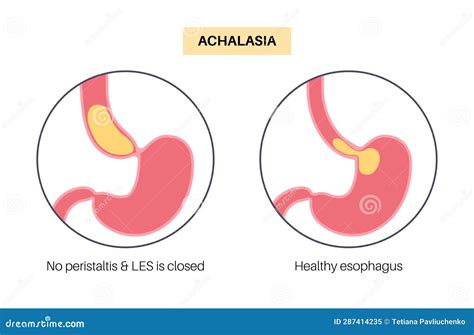 Enfermedad De La Acalasia Esofágica Ilustración Del Vector
