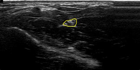 Deep Learning With Spatiotemporal Consistency For Nerve Segmentation In Ultrasound Images Deepai