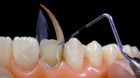 Discolored Lateral Incisor Prep Matrixing And Bonding Spear Education