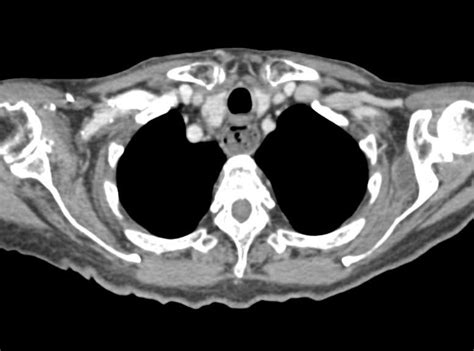 Esophageal Diverticulum Esophagus Case Studies Ctisus Ct Scanning
