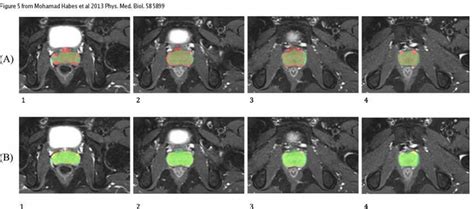 Segmentation Results Of The SVM Based Approach Segmentation Results Of