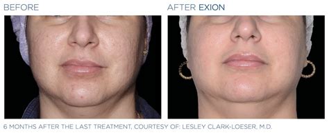 Pimple Scar Reduction Pulse Body Rejuvenation Adelaide