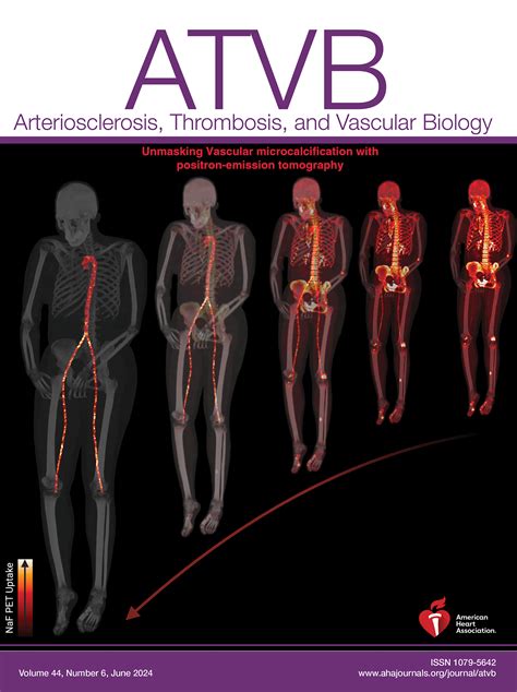 Role Of The Lymphatics In Cardiac Disease Arteriosclerosis
