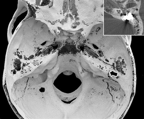 Ct Of Skull Base Fractures Classification Systems Complications And Management Radiographics